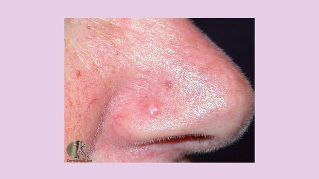 Fibrous and Fibrohistiocytic Proliferations of the Skin P1 | PPT