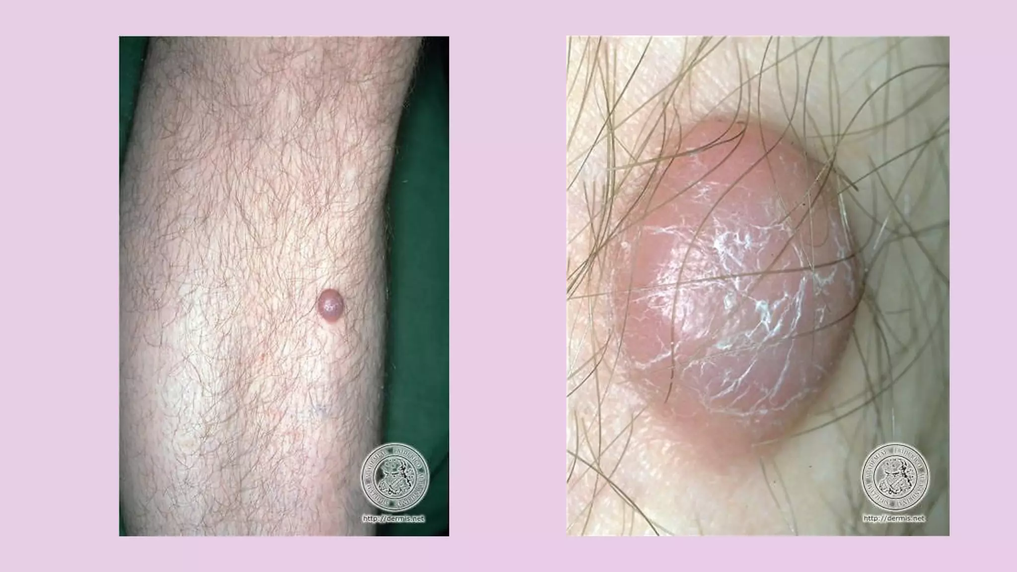 Fibrous and Fibrohistiocytic Proliferations of the Skin P.II