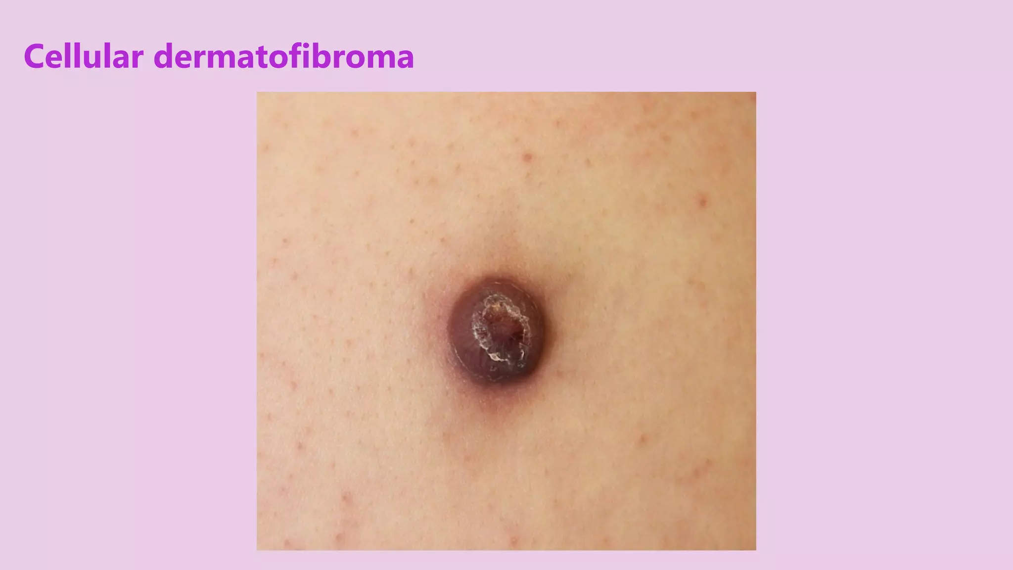 Fibrous and Fibrohistiocytic Proliferations of the Skin P.II