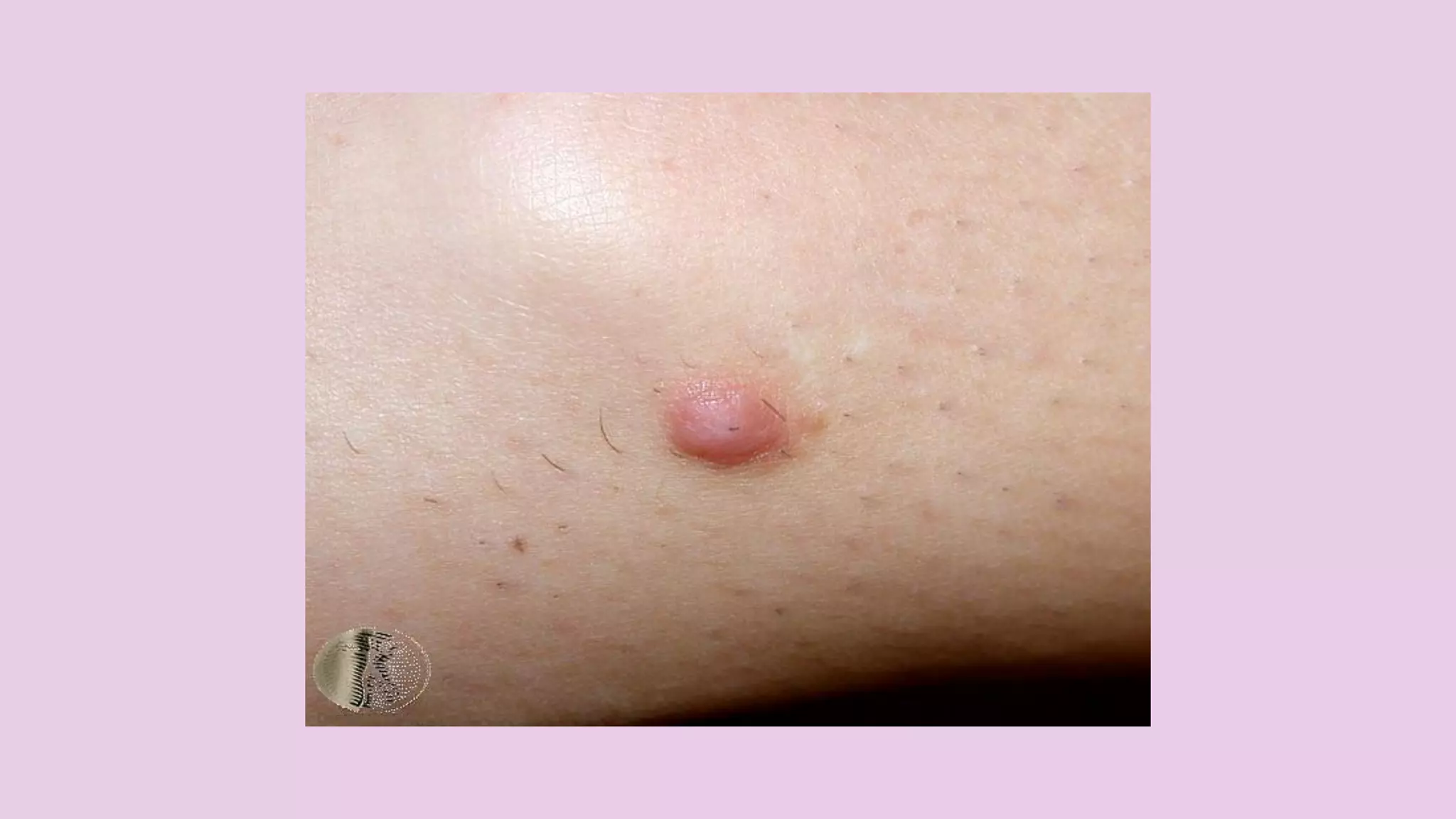 Fibrous and Fibrohistiocytic Proliferations of the Skin P.II