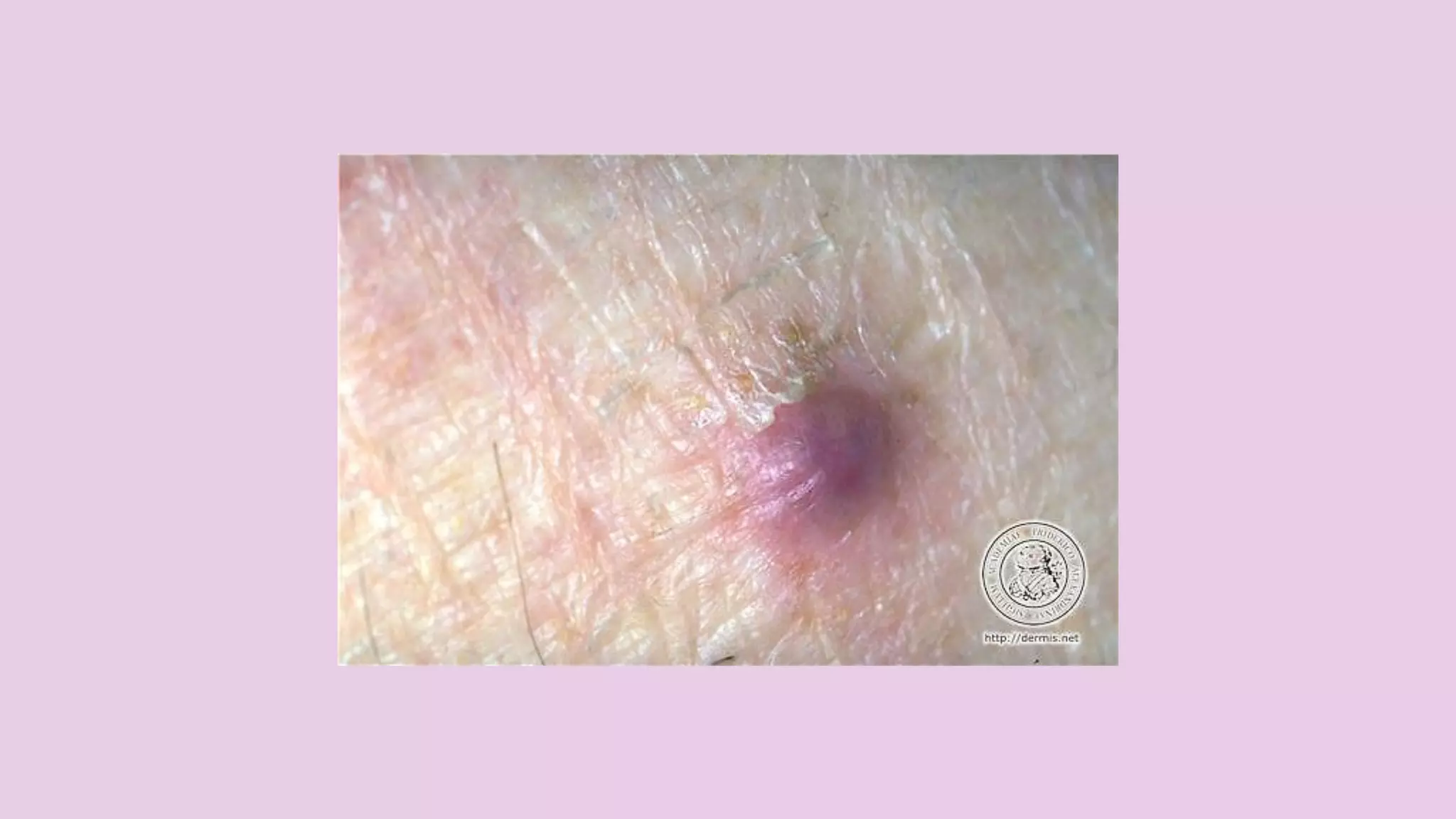 Fibrous and Fibrohistiocytic Proliferations of the Skin P.II