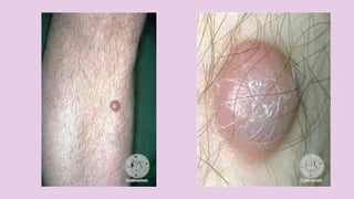 Fibrous and Fibrohistiocytic Proliferations of the Skin P.II