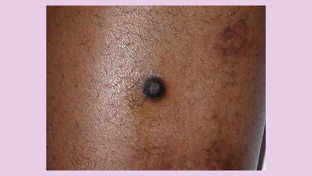 Fibrous and Fibrohistiocytic Proliferations of the Skin P.II | Skin and ...
