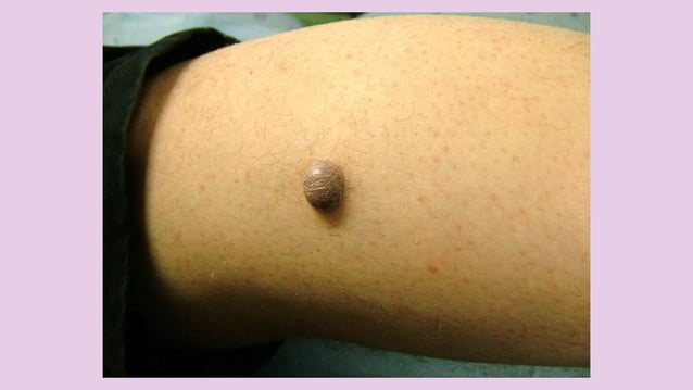 Fibrous and Fibrohistiocytic Proliferations of the Skin P.II | Skin and ...