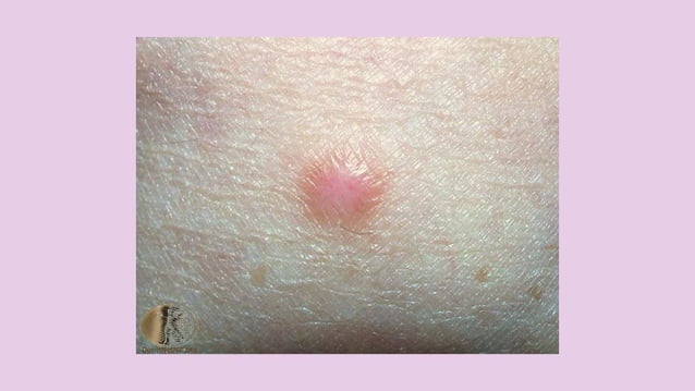 Fibrous and Fibrohistiocytic Proliferations of the Skin P.II | Skin and ...