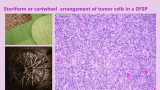 Fibrous and Fibrohistiocytic Proliferations of the Skin P.II