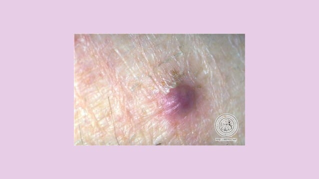 Fibrous and Fibrohistiocytic Proliferations of the Skin P.II | Skin and ...