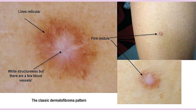 Fibrous and Fibrohistiocytic Proliferations of the Skin P.II