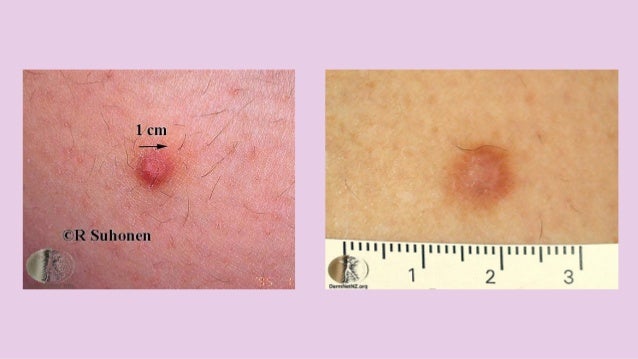 Fibrous and Fibrohistiocytic Proliferations of the Skin P.II