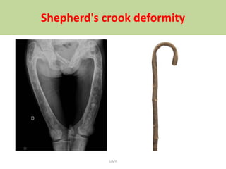 Fibrous Dysplasia & other fibrous lesions | PPT