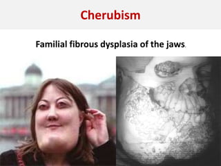 Fibrous Dysplasia & other fibrous lesions | PPTX
