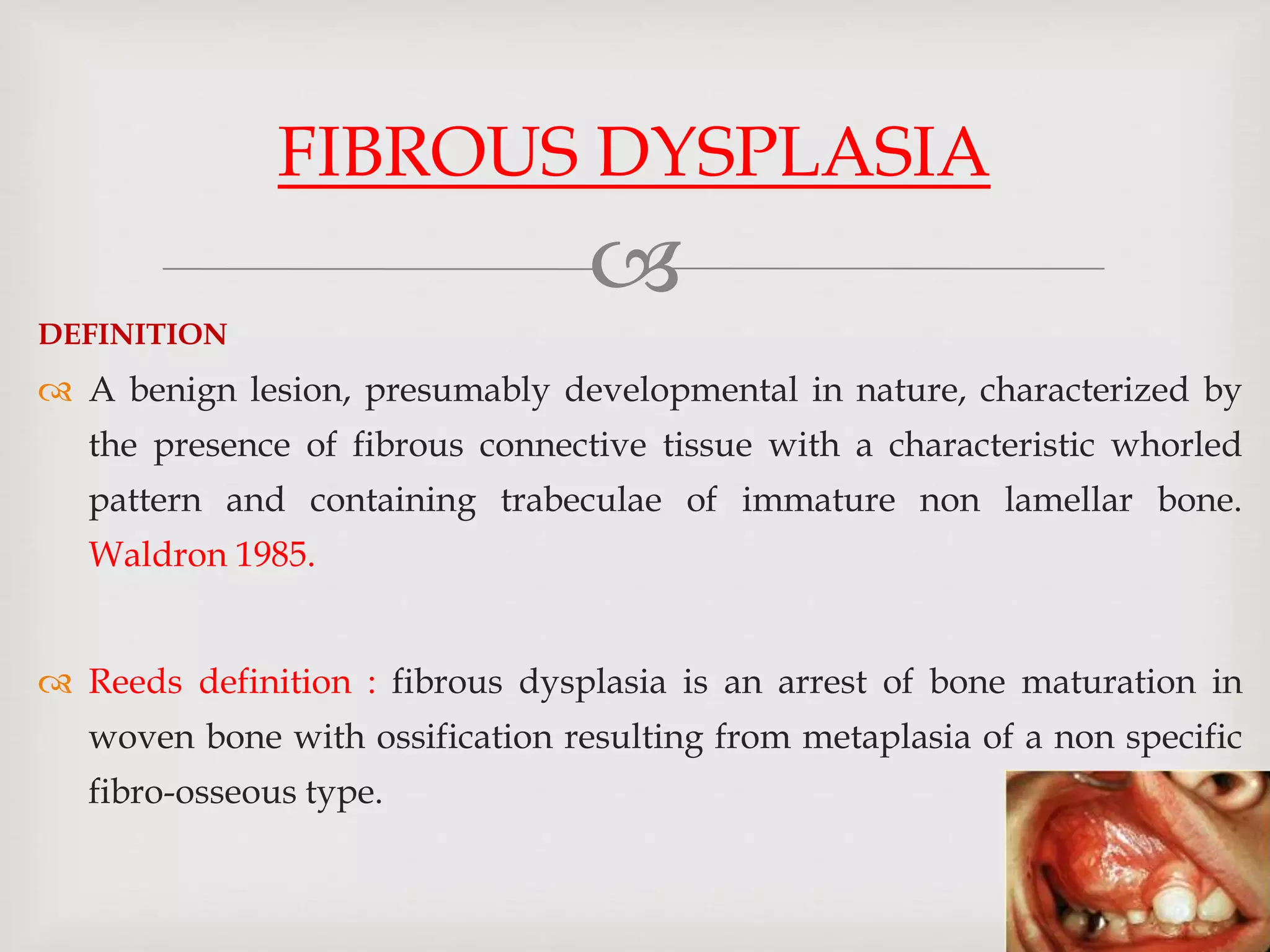Fibrousdysplasia | PPTX