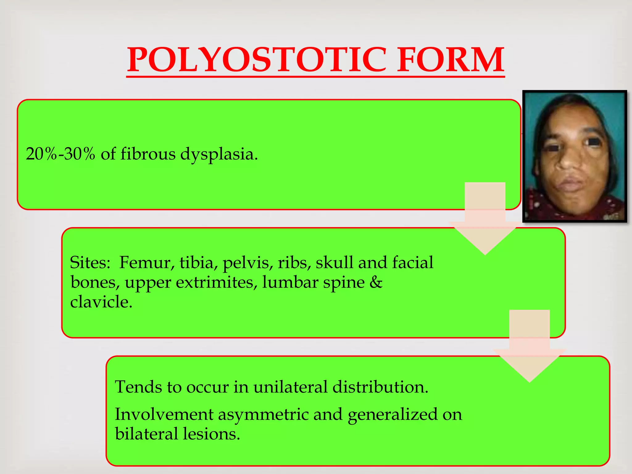 Fibrousdysplasia | PPTX