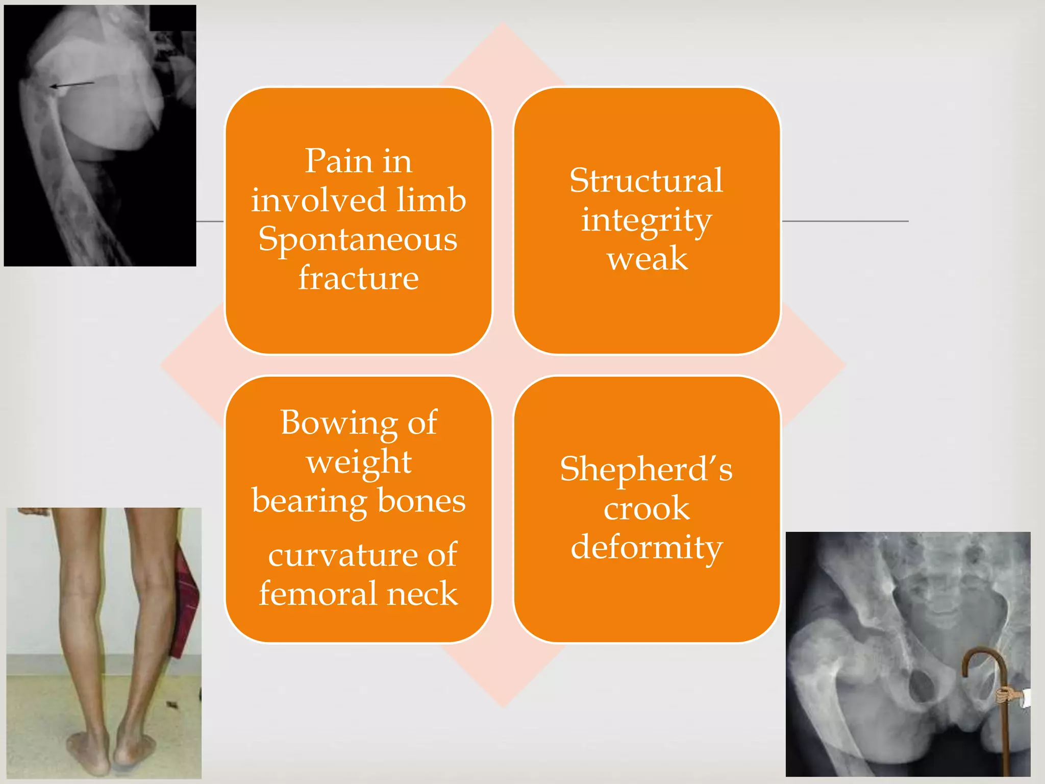 Fibrousdysplasia | PPTX