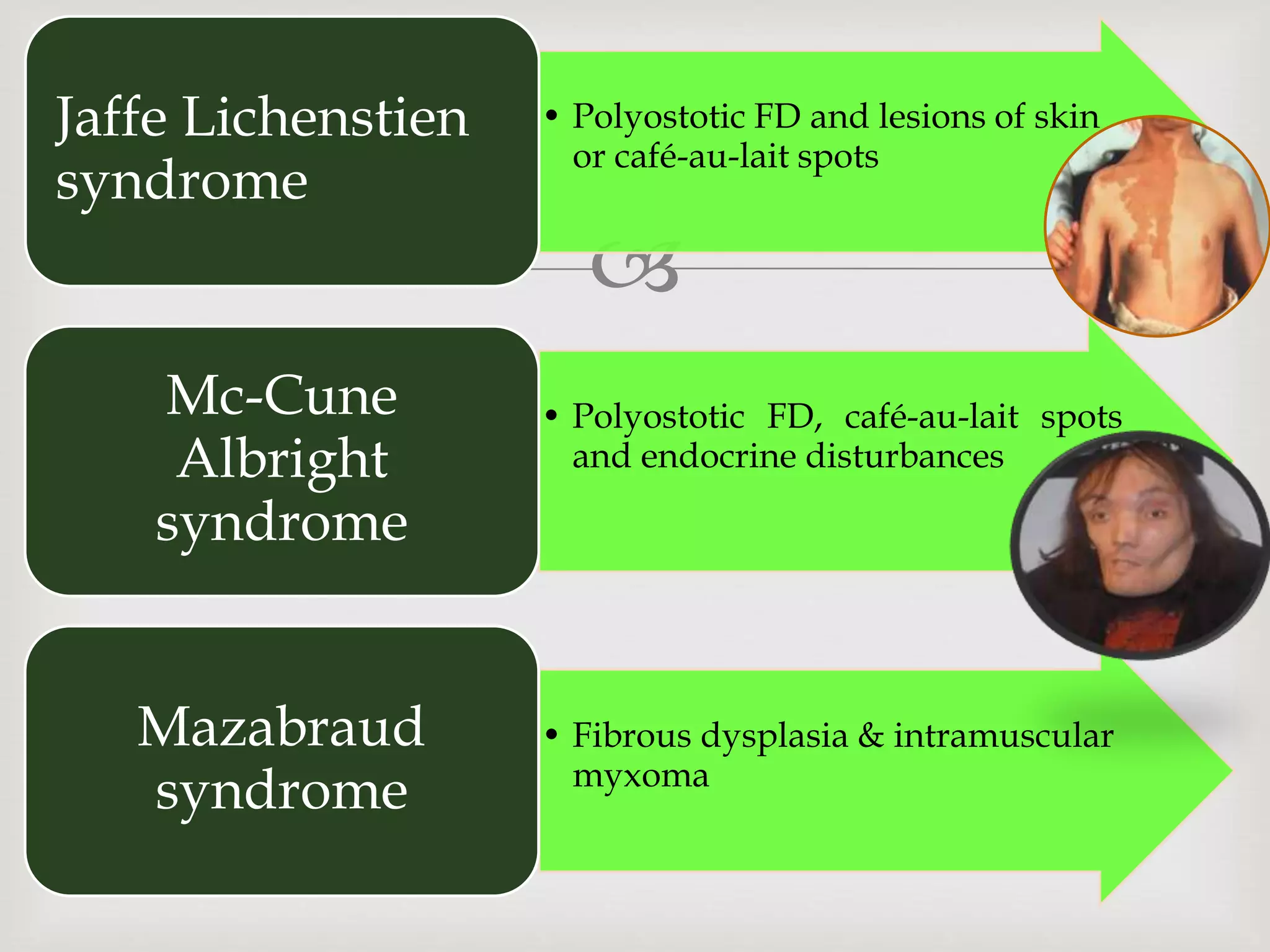 Fibrousdysplasia | PPTX