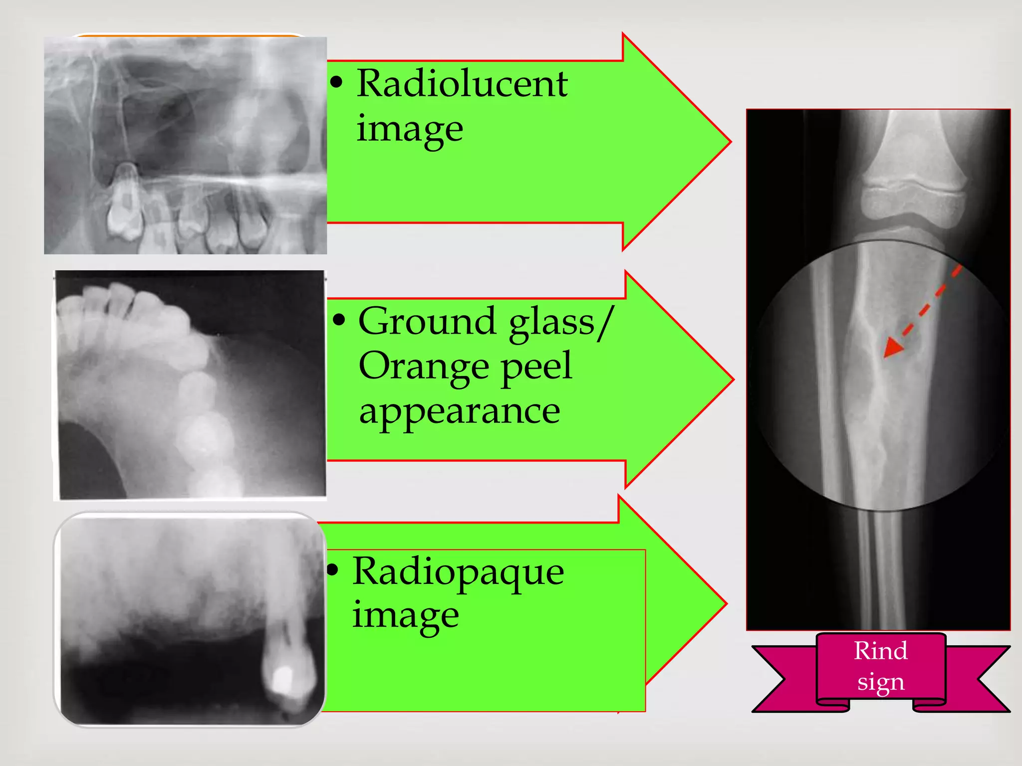 Fibrousdysplasia | PPTX