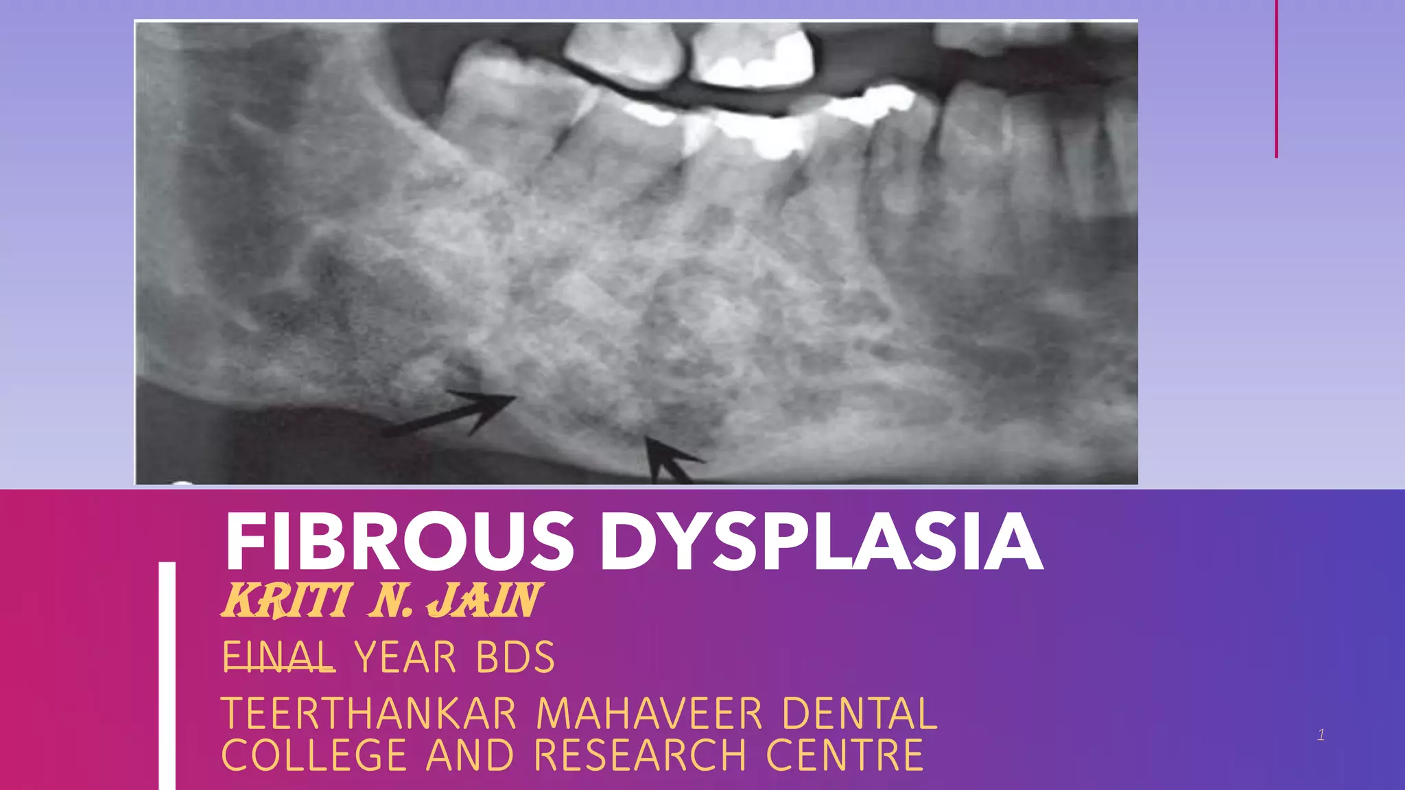 Fibrous dysplasia - BONE LESION OF THE JAW | PPTX