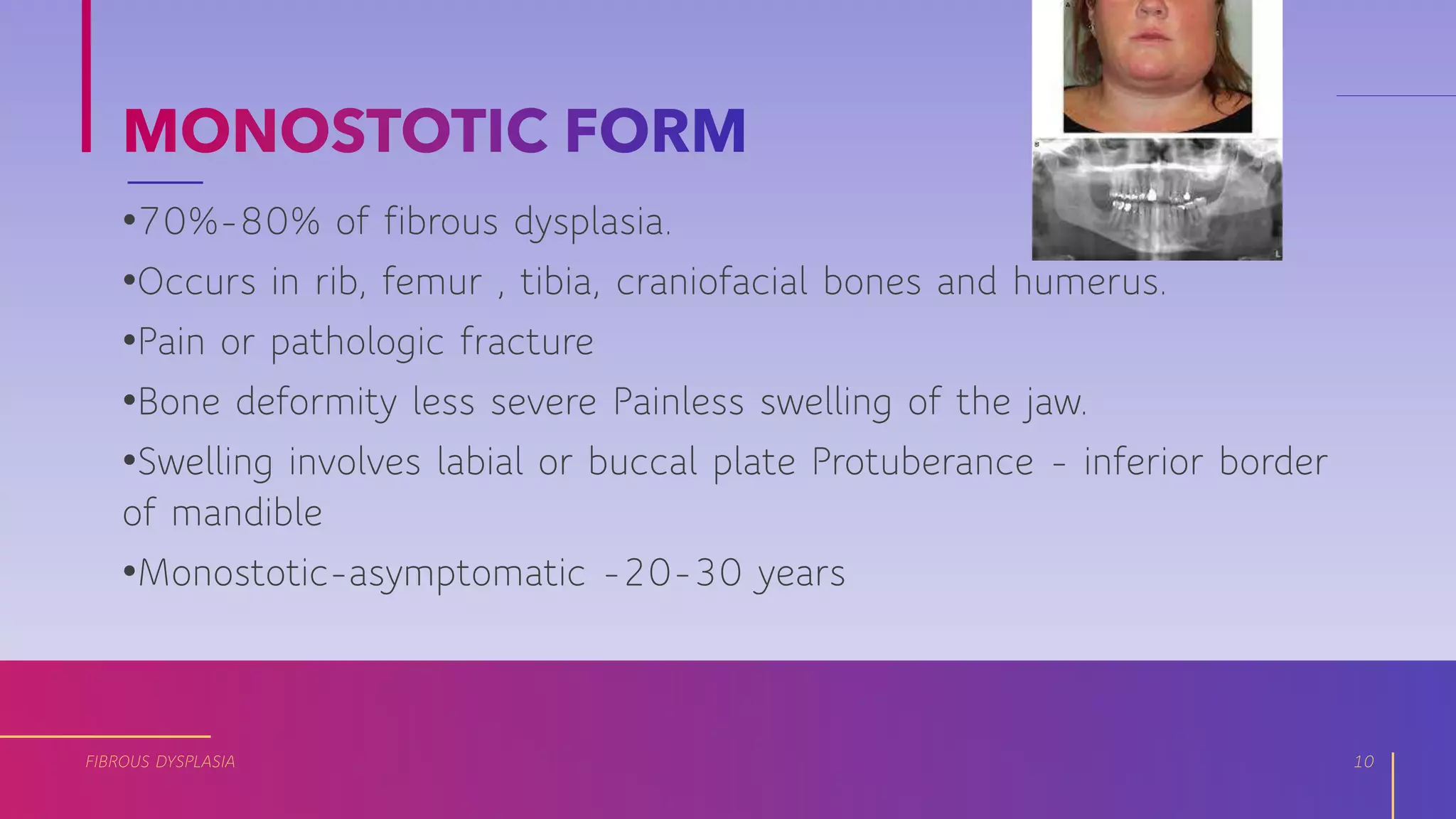 Fibrous dysplasia - BONE LESION OF THE JAW | PPTX