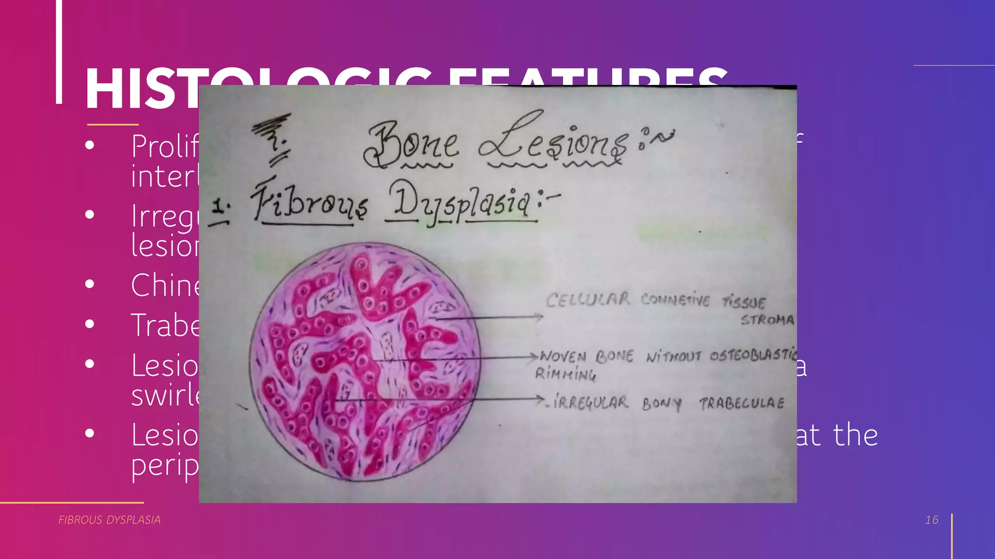 Fibrous dysplasia - BONE LESION OF THE JAW | PPTX