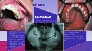 Fibrous dysplasia - BONE LESION OF THE JAW | PPTX