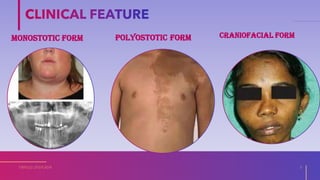 Fibrous dysplasia - BONE LESION OF THE JAW | PPTX