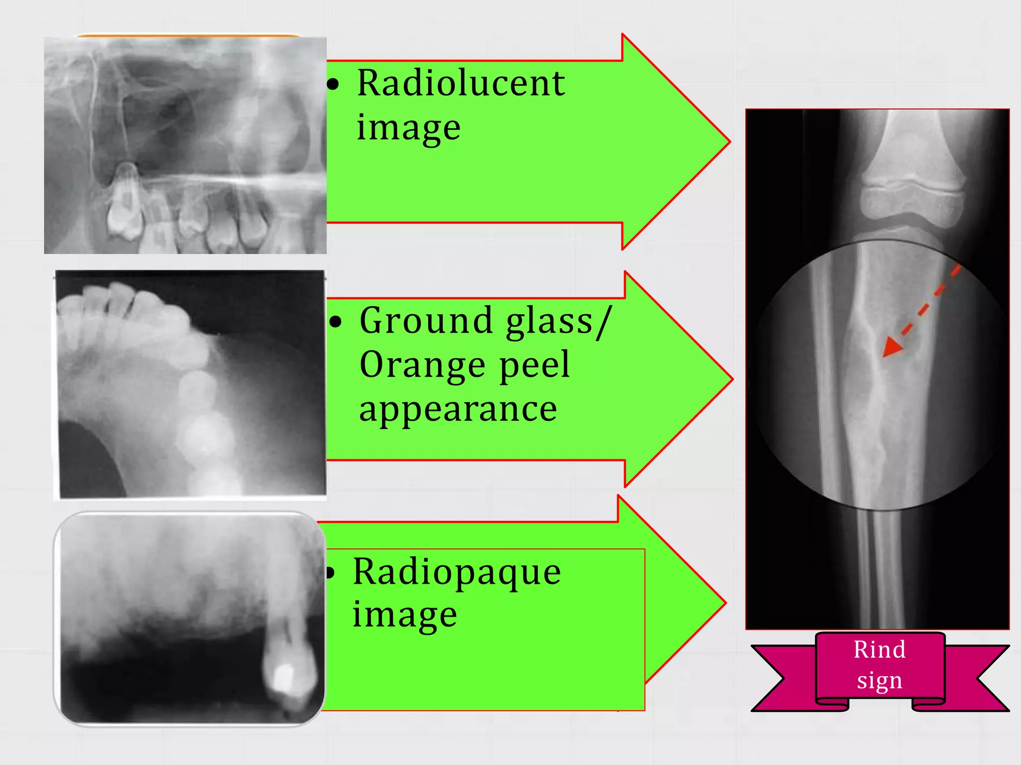 Fibrous dysplasia.pptx