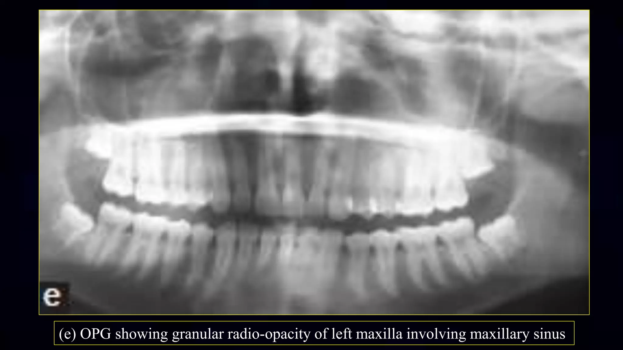 Fibrous dysplasia of maxilla | PPTX