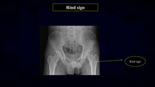 Fibrous dysplasia of maxilla | PPTX
