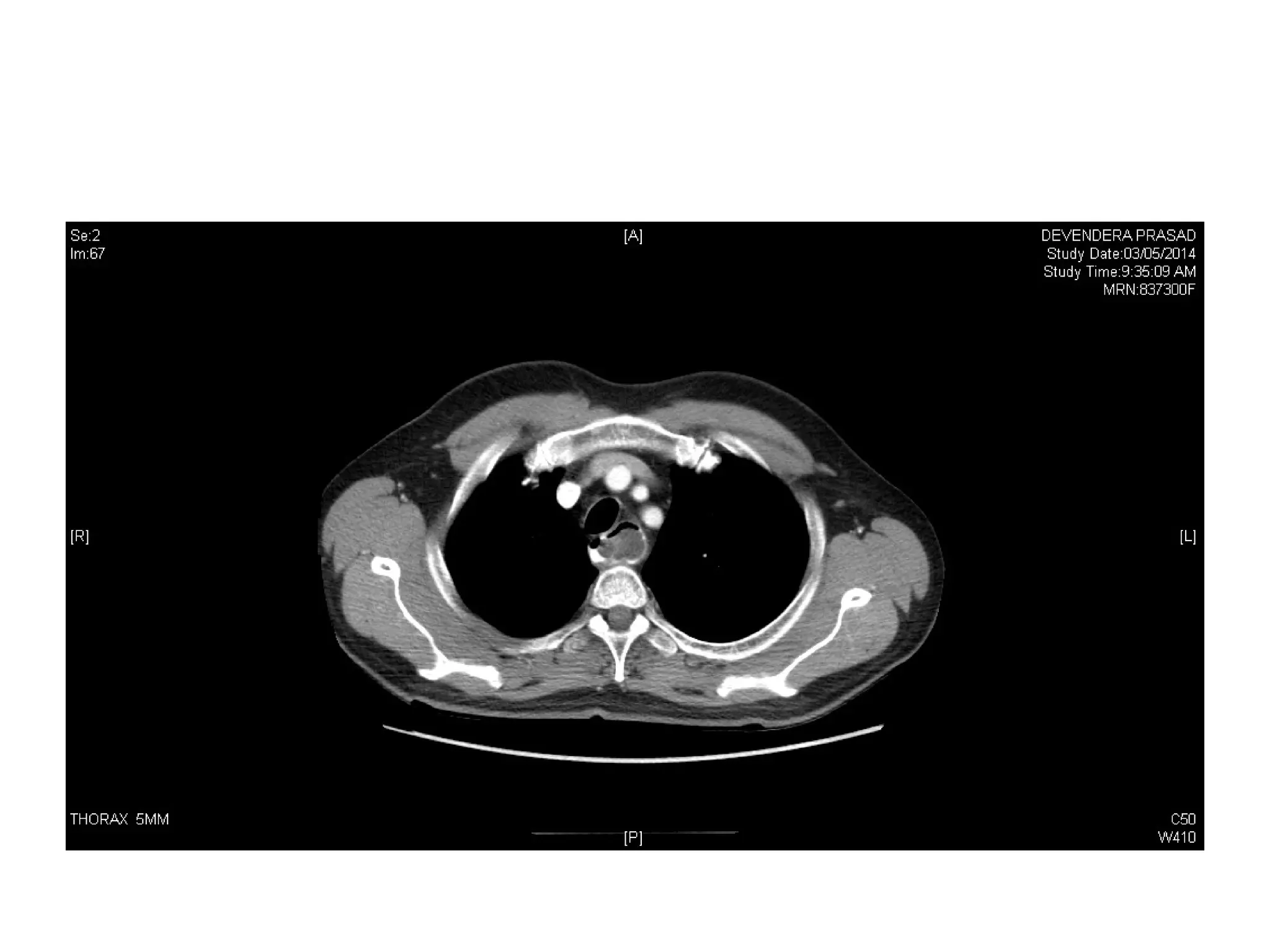 Fibrovascular polyp | PPT