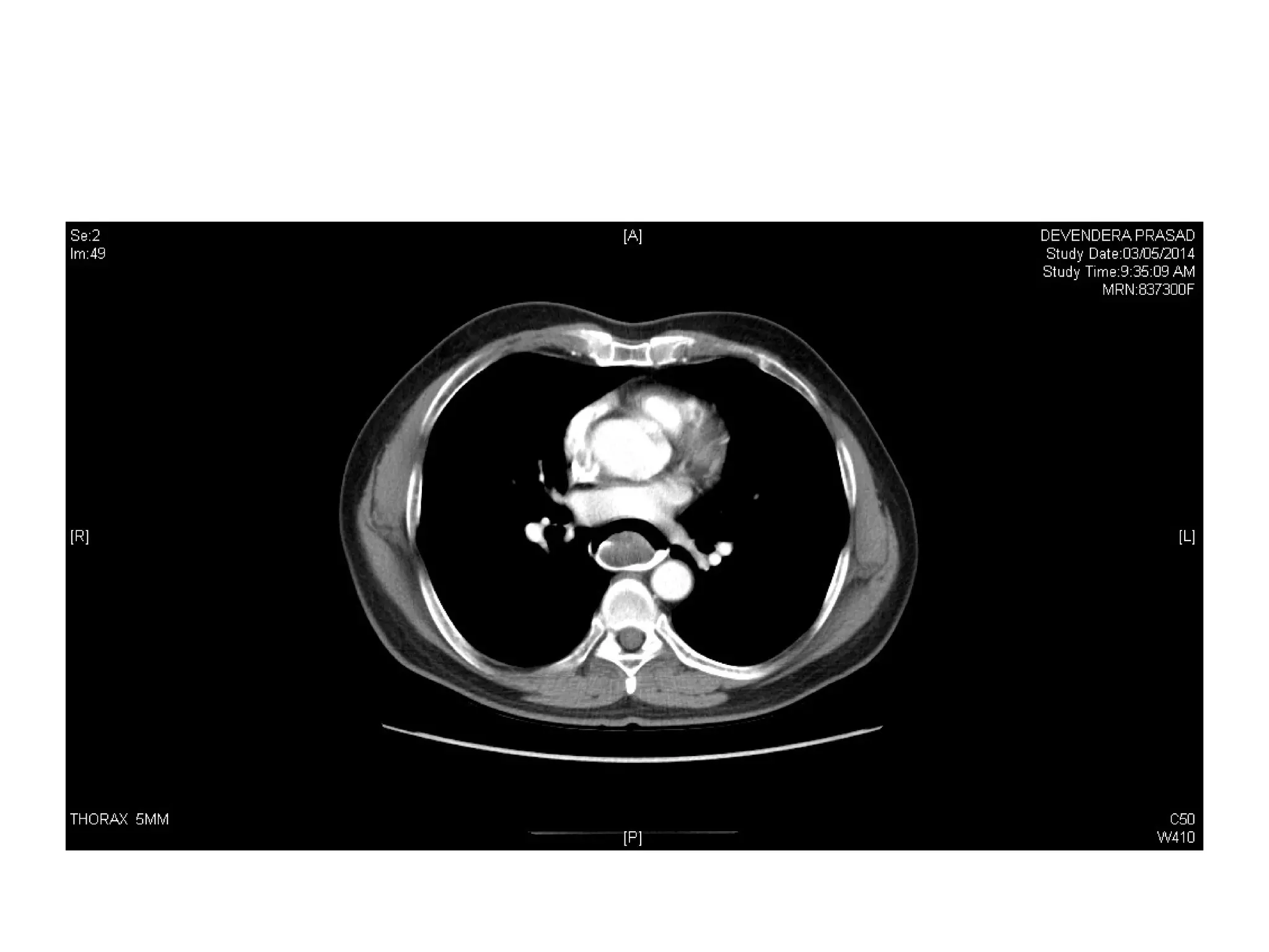 Fibrovascular polyp | PPT