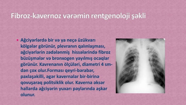Fibroz kaveroz vərəm | PPT
