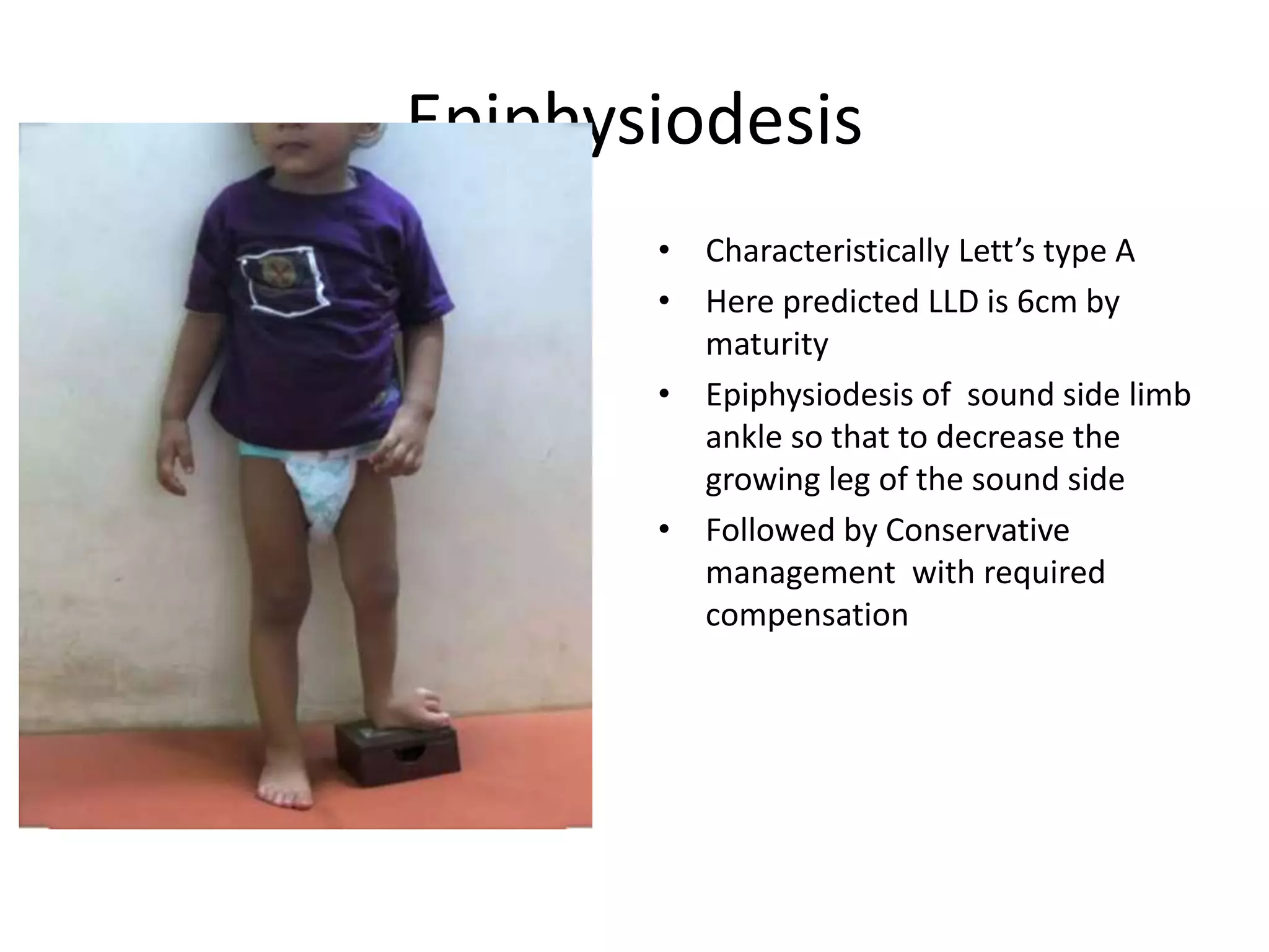 Fibular deficiency and management.pptx