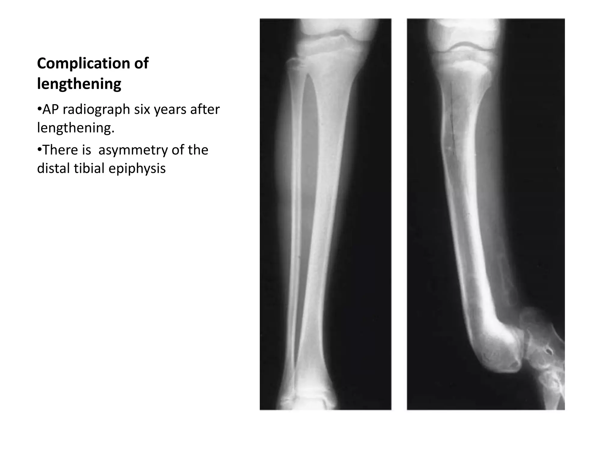 Fibular deficiency and management.pptx