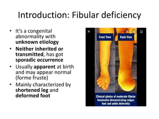 Fibular deficiency and management.pptx