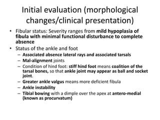 Fibular deficiency and management.pptx