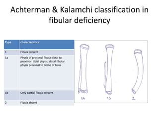 Fibular deficiency and management.pptx