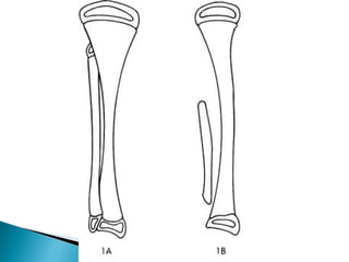 Fibular hemimelia | PPT