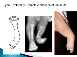 Fibular Hemimelia