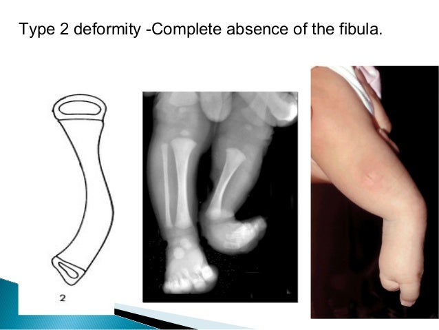 Fibular hemimelia
