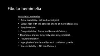 Fibular hemimelia | PPT