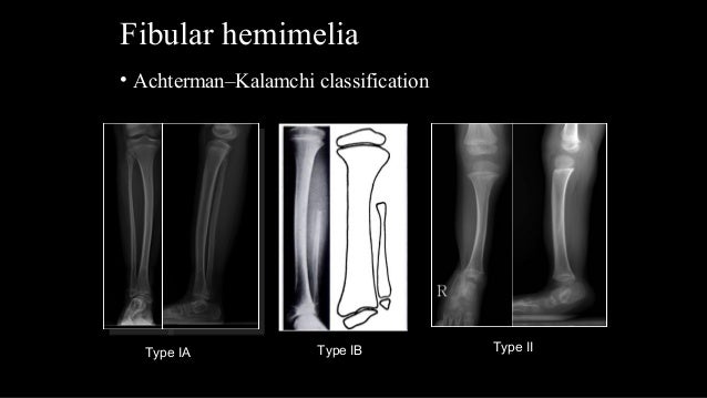 Fibular hemimelia