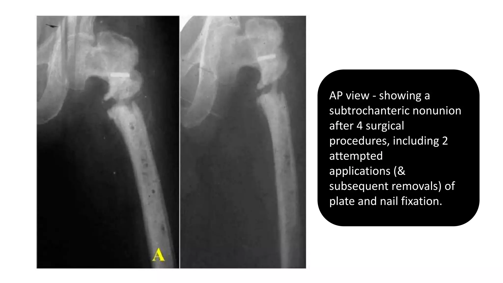 Fibular strut | PPTX