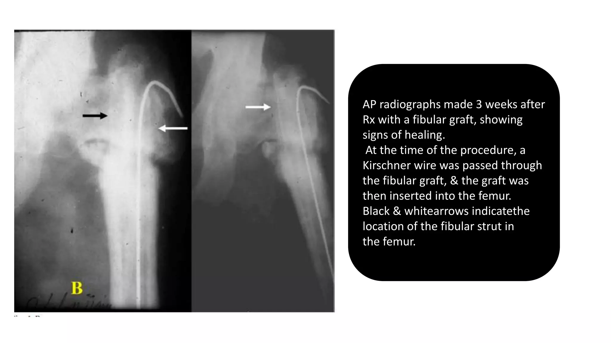Fibular strut | PPTX