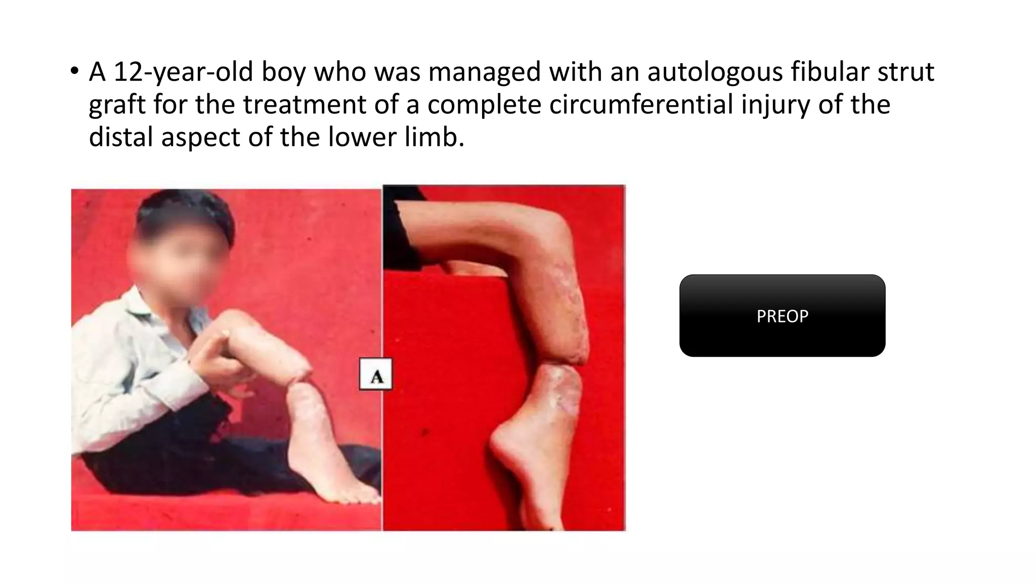 Fibular strut | PPTX