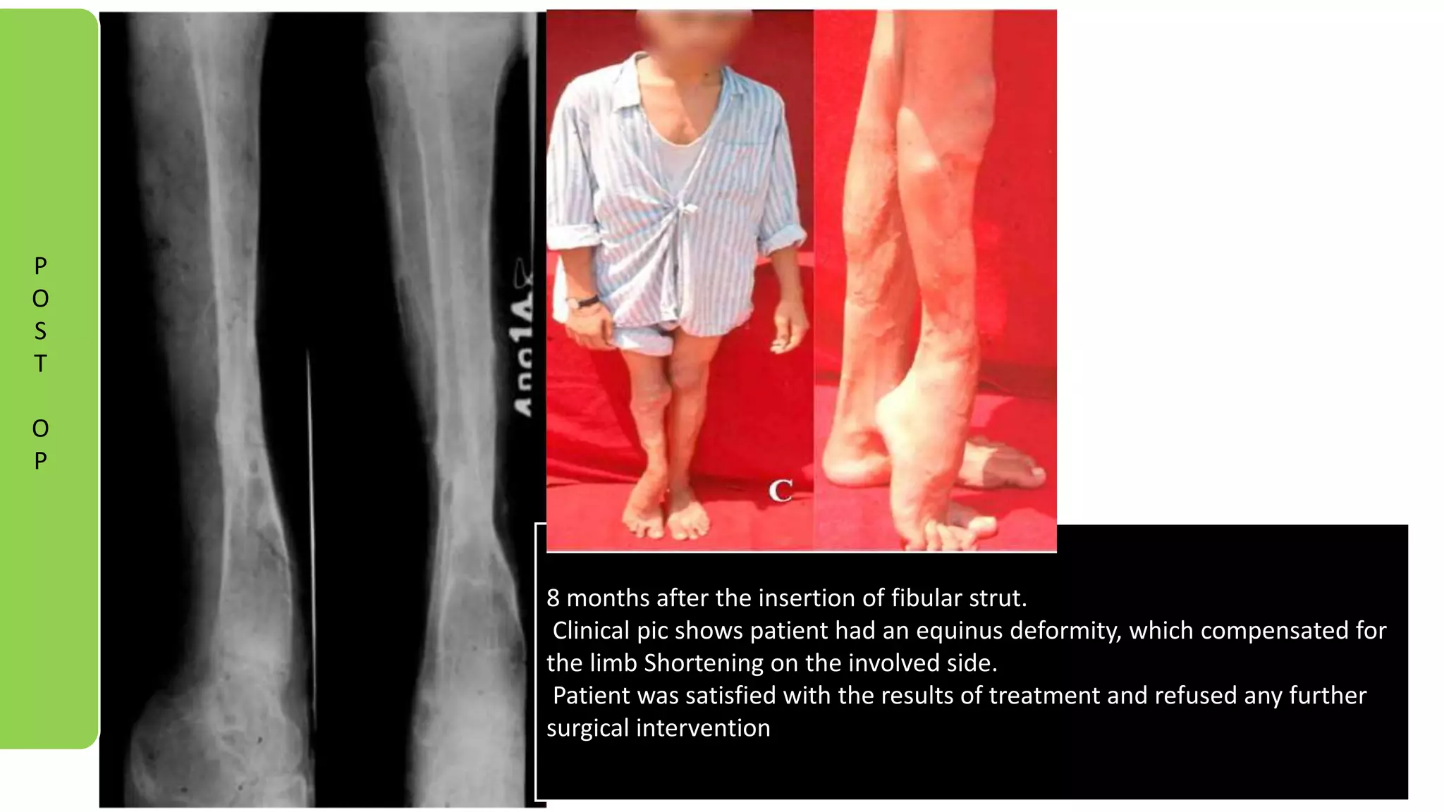 Fibular strut | PPTX