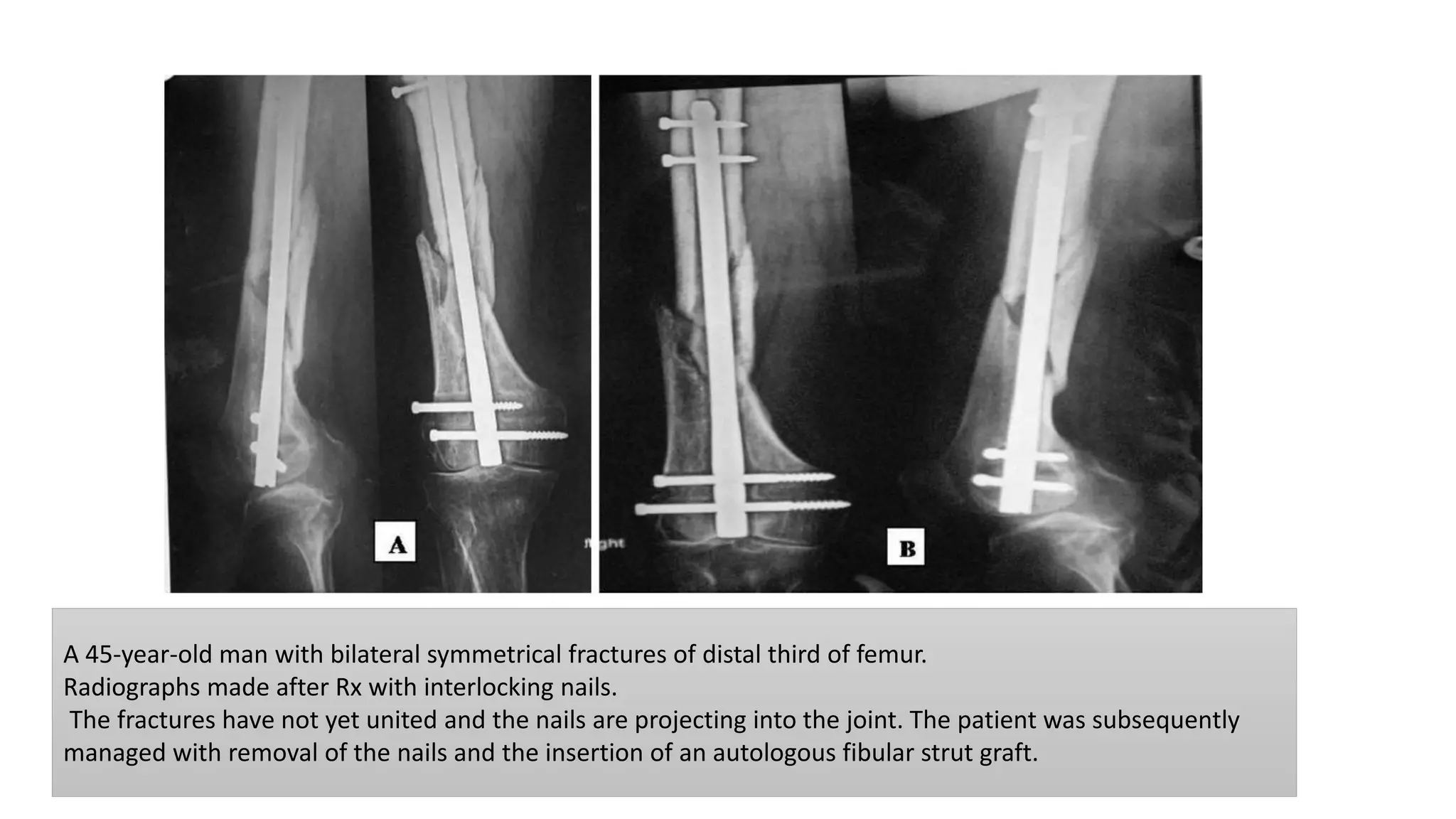 Fibular strut | PPTX