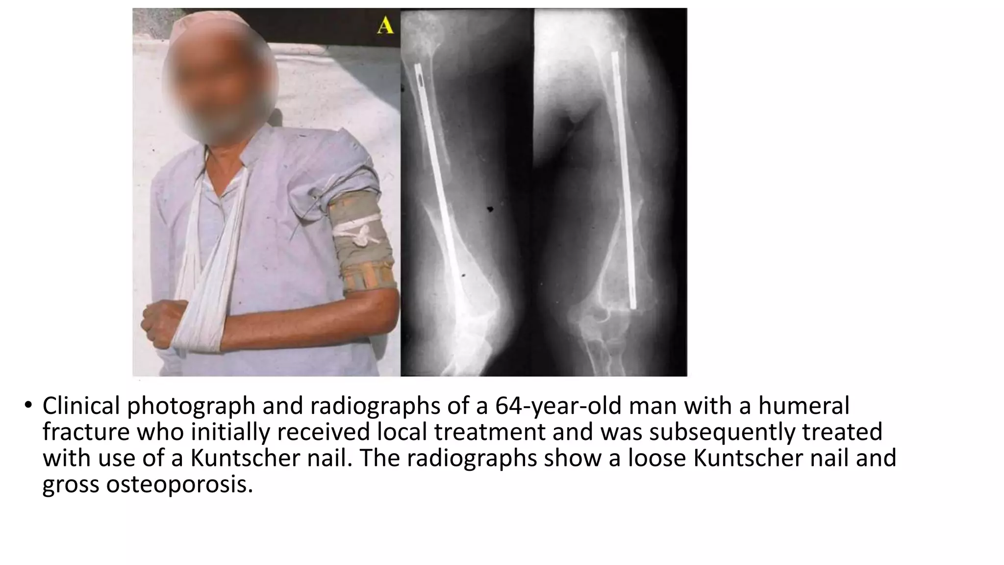 Fibular strut | PPTX