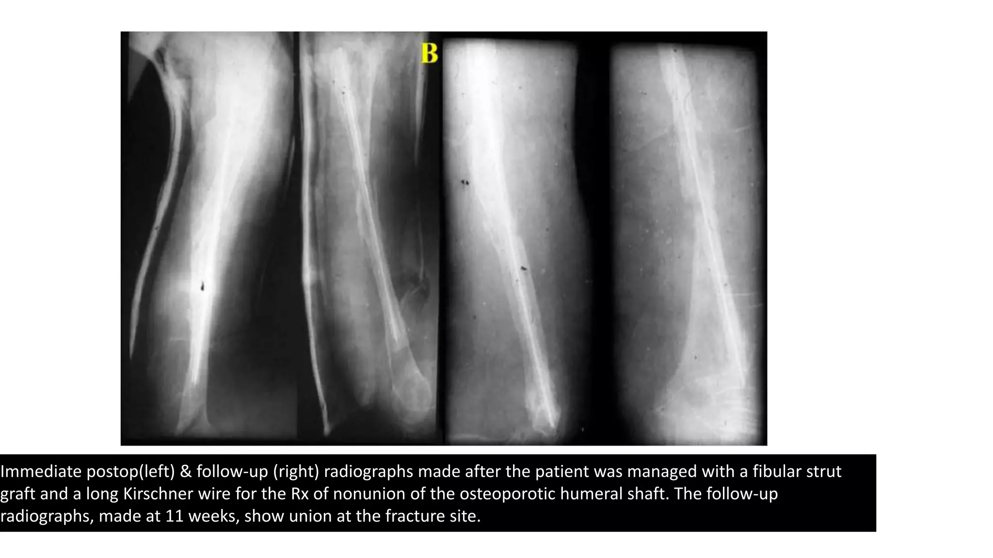 Fibular strut | PPTX