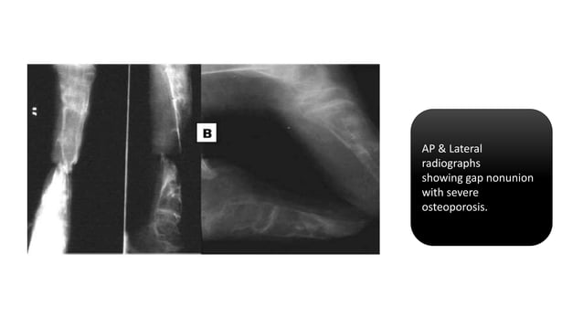 Fibular strut | PPTX | Death, Injury, or Military Conflict | Sensitive Topics