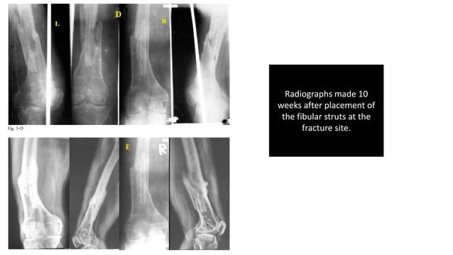 Fibular strut | PPTX | Death, Injury, or Military Conflict | Sensitive ...